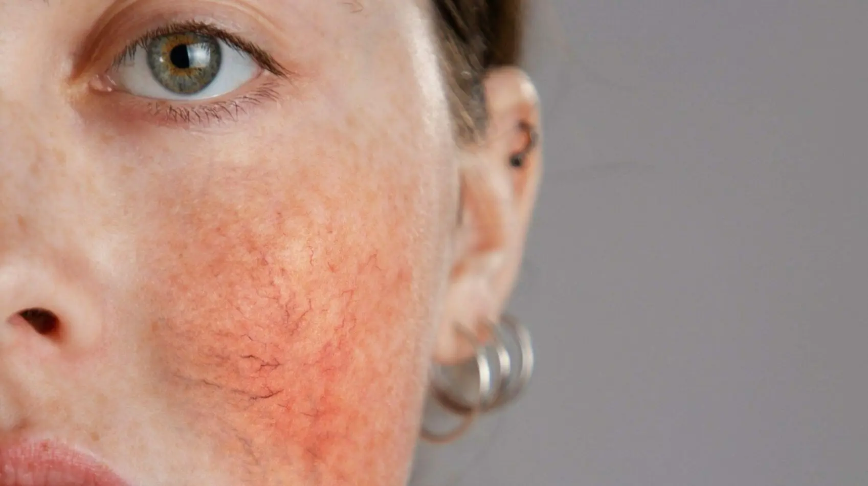 Veido rožinė: kai veidas rausta ne tik iš drovumo - Sokratoclinica.lt